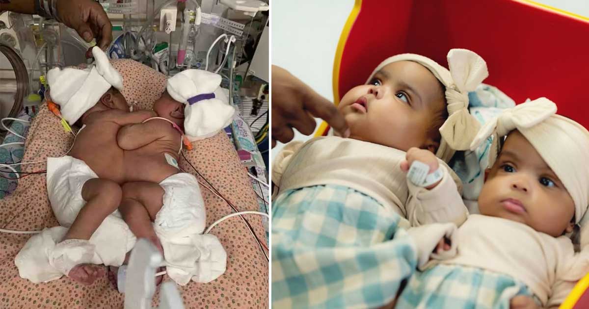After surgery, conjoined twins are now home with their family
