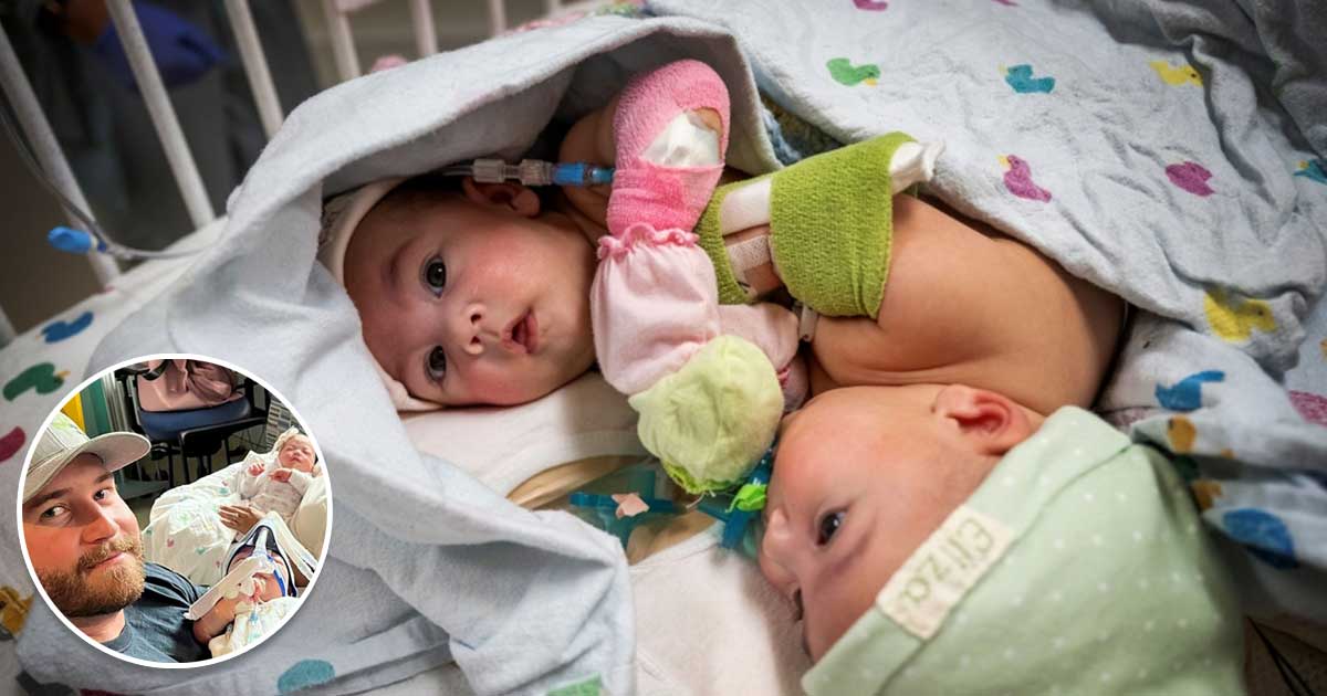 Twins conjoined at the abdomen separation surgery