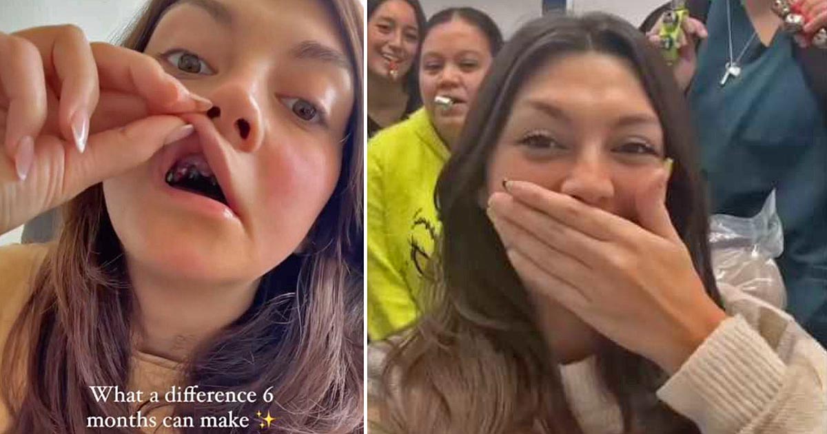 Woman's Journey to New Teeth After Getting Dental Implants