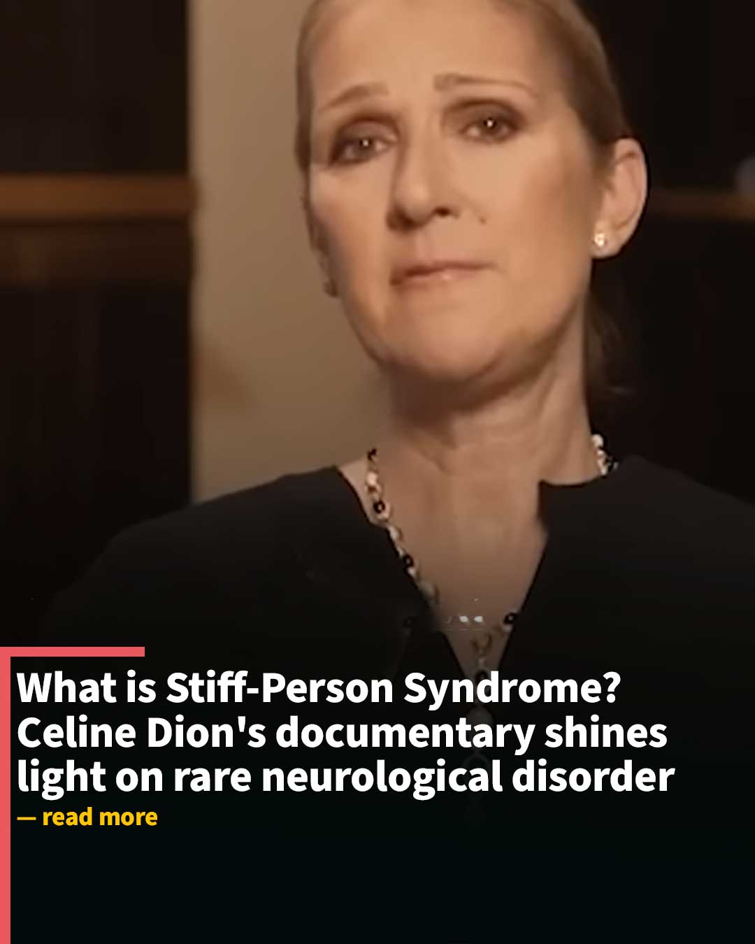 What is Stiff-Person Syndrome?