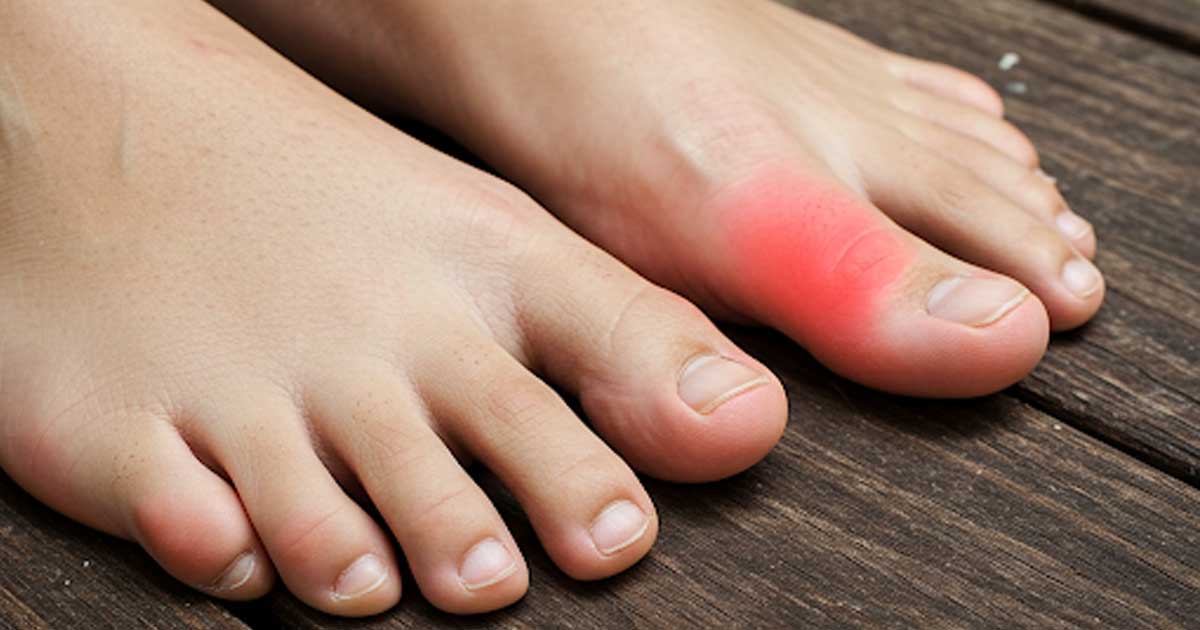 Gout Relief: Supplements to Lower Uric Acid
